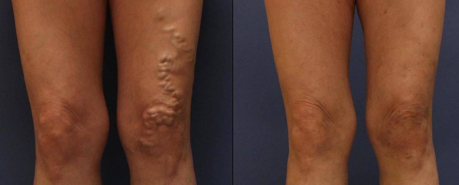 A Comprehensive Look at Varicose Vein Removal